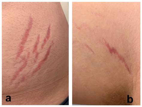 Bartonella Associated Cutaneous Lesions Bacl In People With