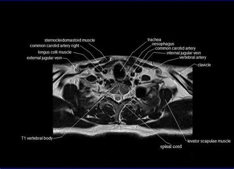 Mri Neck Anatomy Free Mri Axial Neck Cross Sectional Anatomy Brain