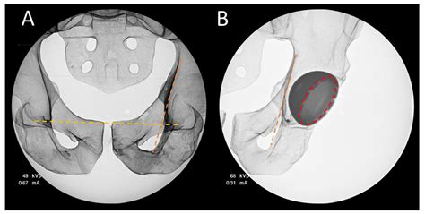 Accuracy And Reliability Of Software Navigation For Acetabular Component Placement In Tha An In