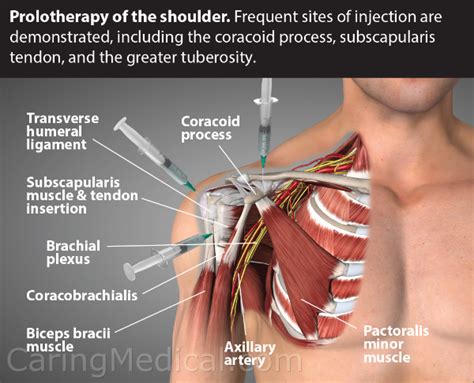 Anterior Shoulder Injection Injections Glasgow Shoulder Clinic