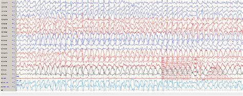 Abnormal Eeg Showing Non Convulsive Status Epilepticus Eeg Download Scientific Diagram