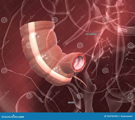 Appendicitis Is A Painful Swelling Of The Appendix Stock Illustration Appendicitis Is A Painful Swelling Of The Appendix Stock Illustration