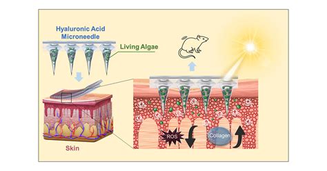 Microalgae Microneedle Supplies Oxygen For Antiphotoaging Treatment ACS Applied Bio Materials