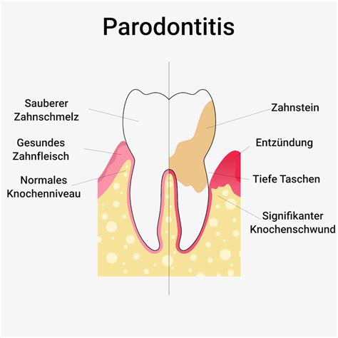 Parodontitis Parodontose Hilfe And Informationen Áyio Q