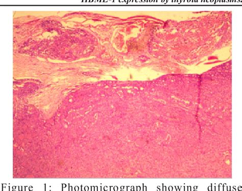 Figure 1 From Hbme 1 Expression By Thyroid Neoplasms In A Nigerian