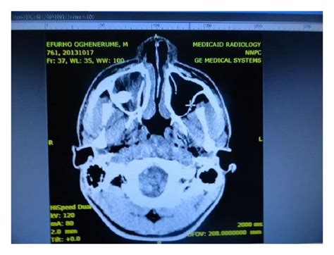 Ct Scan Showing Location Of An Ectopic Tooth In The Posterior Wall Of