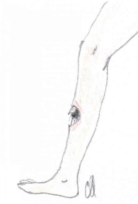 Open Fractures Gustilo Anderson Classification