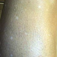 Idiopathic Guttate Hypomelanosis