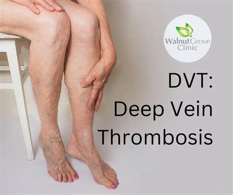 Deep Vein Thrombosis An Informative Guide Walnut Grove Blog