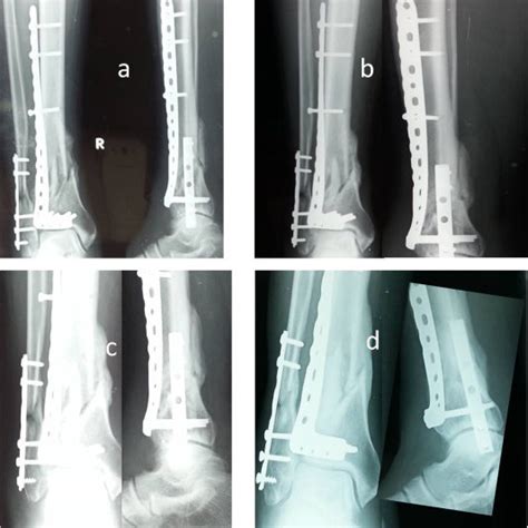 Pdf Minimally Invasive Osteosynthesis Of Distal Tibial Fractures Using Anterolateral Locking