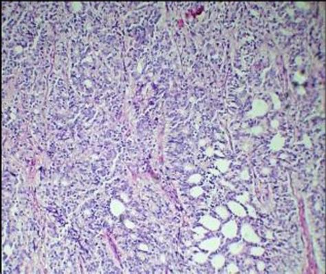 Photomicrograph Showing Gleason Score Of 734 Primary Pattern Being
