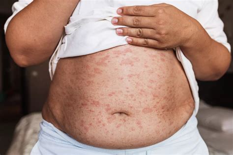 Stomach Rash Stress Viral And Other Symptom Causes