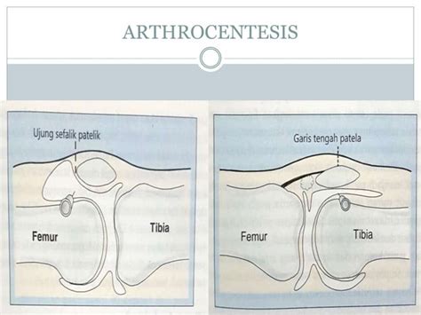 Diagnostic Approach To Knee Joint Effusion Pptx
