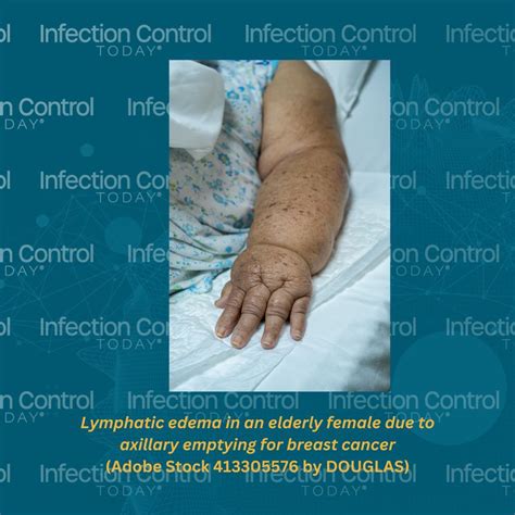 Comprehensive Guide To Lymphedema Causes Prevention And Management