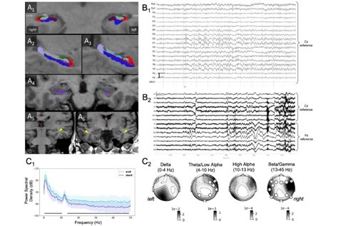 Structural Mri Showing A Partial Incomplete Hippocampal Inversion A1 Download Scientific