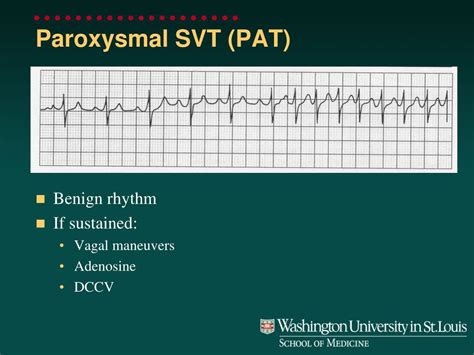 Ppt Telemetry Arrythmias Powerpoint Presentation Free Download Id 4635437