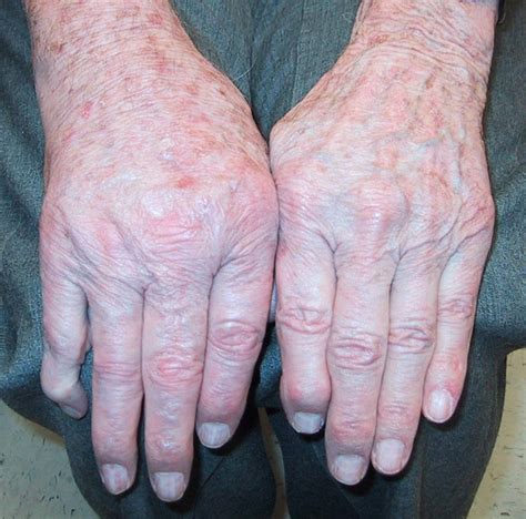 2023 Acr Eular Criteria For Calcium Pyrophosphate Deposition Disease Rheumnow