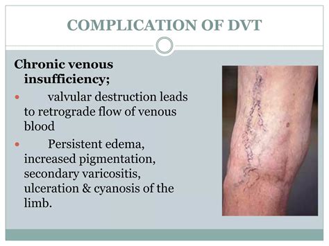 Dvt Deep Vein Thrombosis Pdf