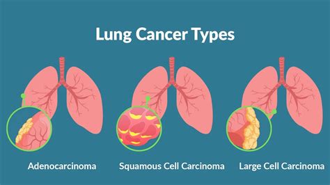 Bronchogenic Carcinoma Types Stages Symptoms And Diagnosis Science