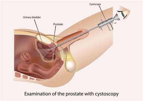Can A Cystoscopy Detect Prostate Cancer