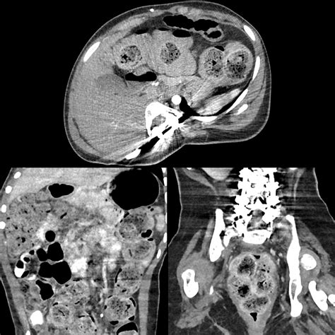 Constipation05mdfeverandconstipationstercoralcolitiswallthickeninganden