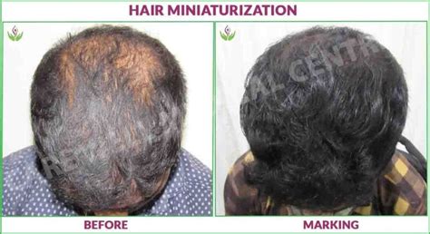 Hair Miniaturization Treatment In Delhi Stop Hair Thinning Care