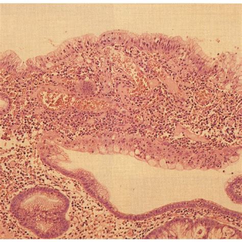 The Foveolar Epithelium Shows Hyperplasia Marked Infiltration Of