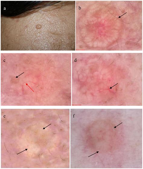 Sebaceous Hyperplasia