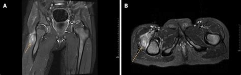 T2 Magnetic Resonance Imaging Of A Three Year Old Girl With Pyomyositis