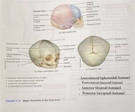 Solved Anterior Fontanel Future Coronal Divida Parietal Bone Suture
