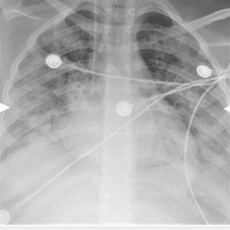 Chest X Ray Showing Bilateral Pulmonary Infiltrates Download Scientific Diagram
