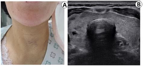 A Case Of Diffuse Thyroid Hematoma After Ultrasound Guided Fine Needle