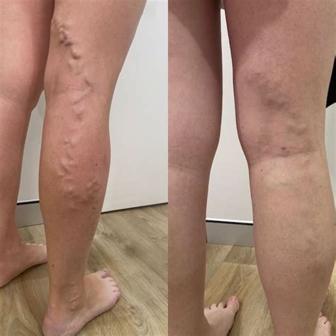 Varicose Veins Surgery Perth Covered By Insurance