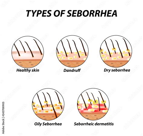 Types Of Seborrhea Seborrhea Skin And Hair Dandruff Seborrheic