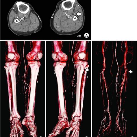 Pdf Common Peroneal Neuropathy With Anterior Tibial Artery Occlusion