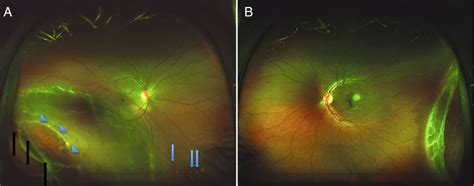 Ultra Wide Field Imaging Of Bilateral Idiopathic Retinal Dialysis Bmj