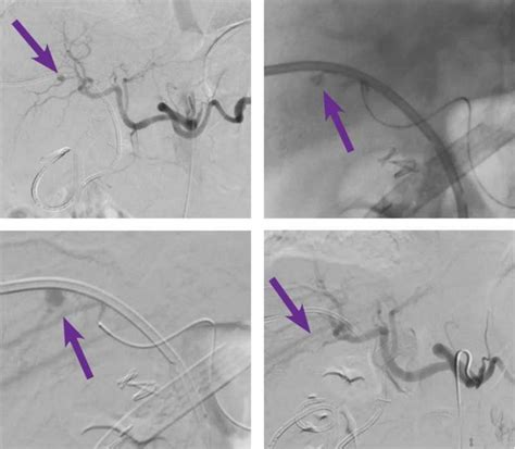 Hepatic Artery Pseudoaneurysm Embolization Obsidio™ Embolic Case