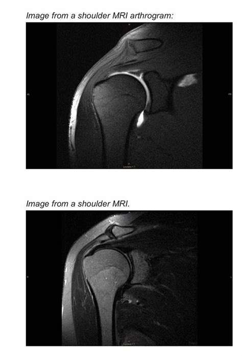 What Is An Mr Arthrogram An Midwest Imaging Centers What Is An Mr Arthrogram An Midwest Imaging Centers