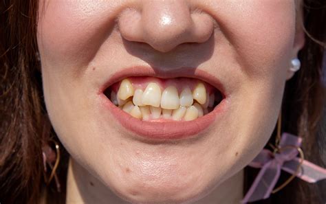 Mastering Malocclusion Management Strategies For A Confident Smile