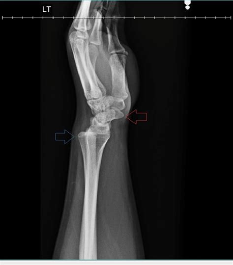 Lateral X Ray Of The Wrist Joint The Distal Ulna Has Undergone Dorsal Download Scientific