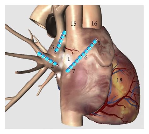 Position Of Catheters In The Atrium 1 Anterior Right Ganglionated