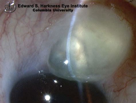 Encapsulated Bleb Vagelos College Of Physicians And Surgeons