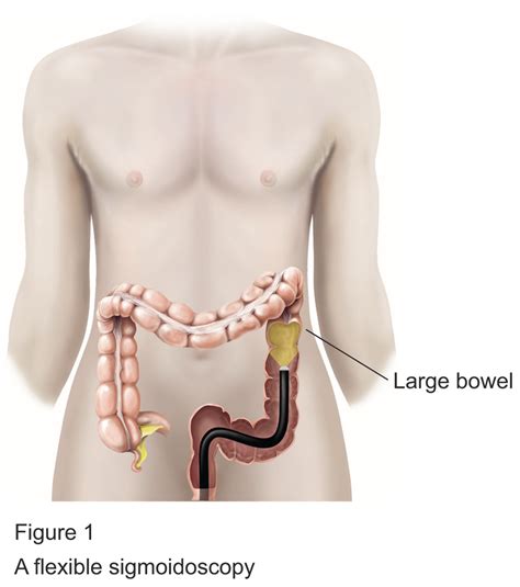Flexible Sigmoidoscopy Procedure Diagram Exeter Gut Clinic