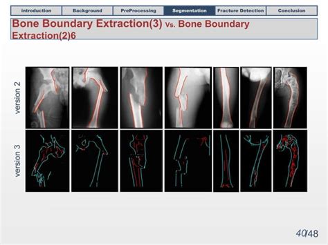 Master Thesis Long Bone Segmentation And Fracture Detection In X Ray