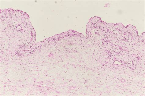 Benign Mullerian Cyst Müllerian Cyst Symptoms Banf