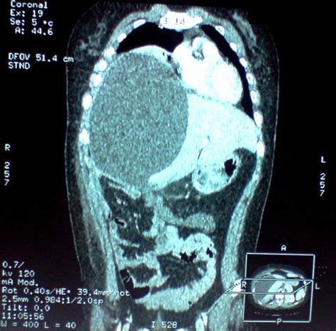 Abdominal Ct Coronal Demonstrated Unilocular Subcapsular Fluid Filled