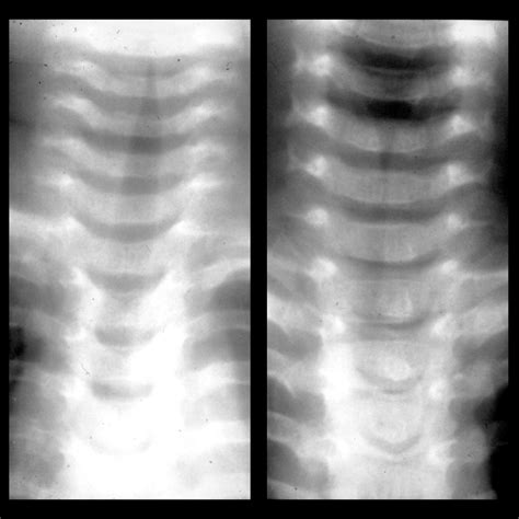 Croup Pediatric Radiology Reference Article Pediatric Imaging