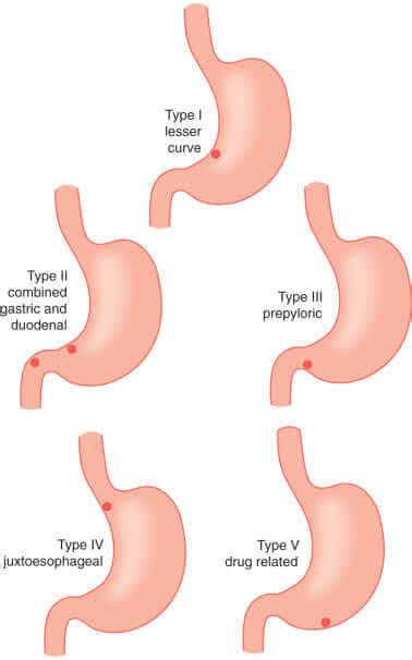 Gastric Ulcer Peptic Ulcer Disease Gastric Vs Duodenal Symptoms