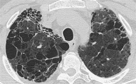 Pneumothorax Ex Vacuo Post Thoracentesis Pneumothorax In The Ultrasound
