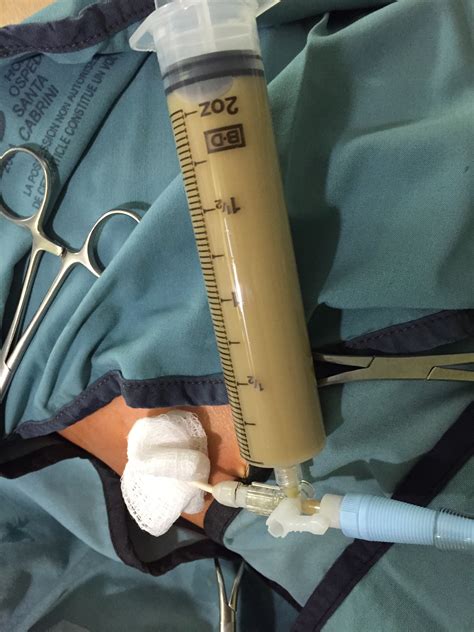 Retropharyngeal Abscess Drainage Cant Miss Pediatric Respiratory Emergencies Slideshow